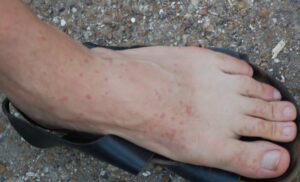 Top 10 Gnat Bites Pictures Explained! | Pest Professional Services