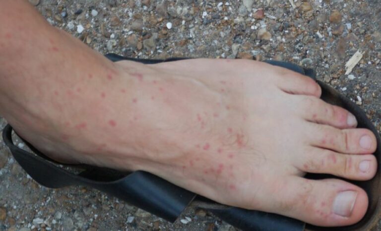 Top 10 Gnat Bites Pictures Explained! | Pest Professional Services